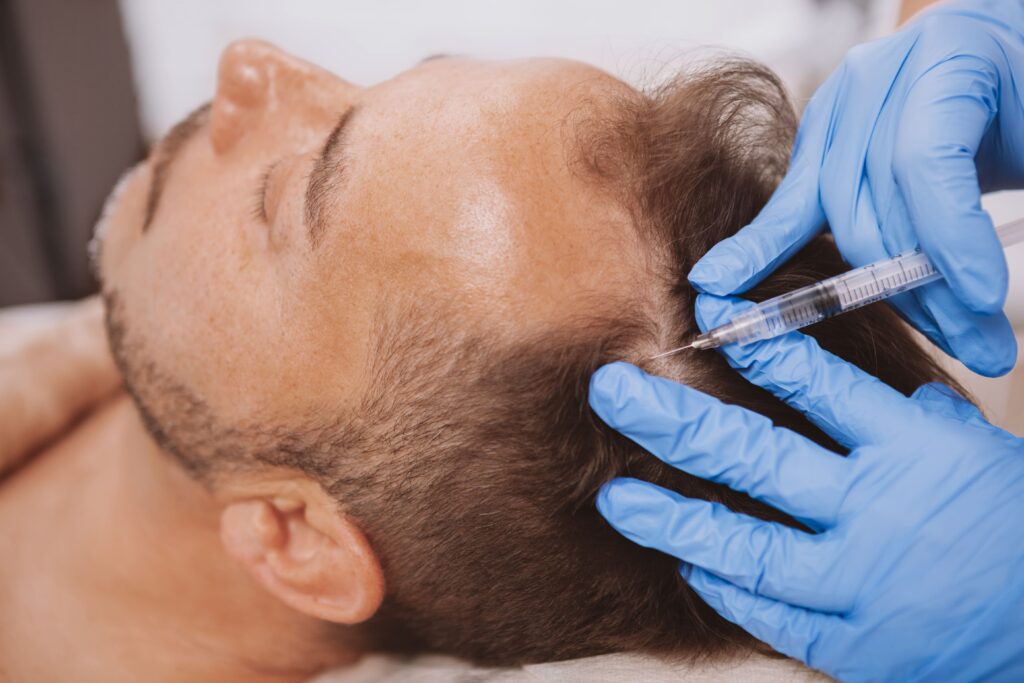 Why PRP is Still the Gold Standard for Hair Loss - The Harley Street ...