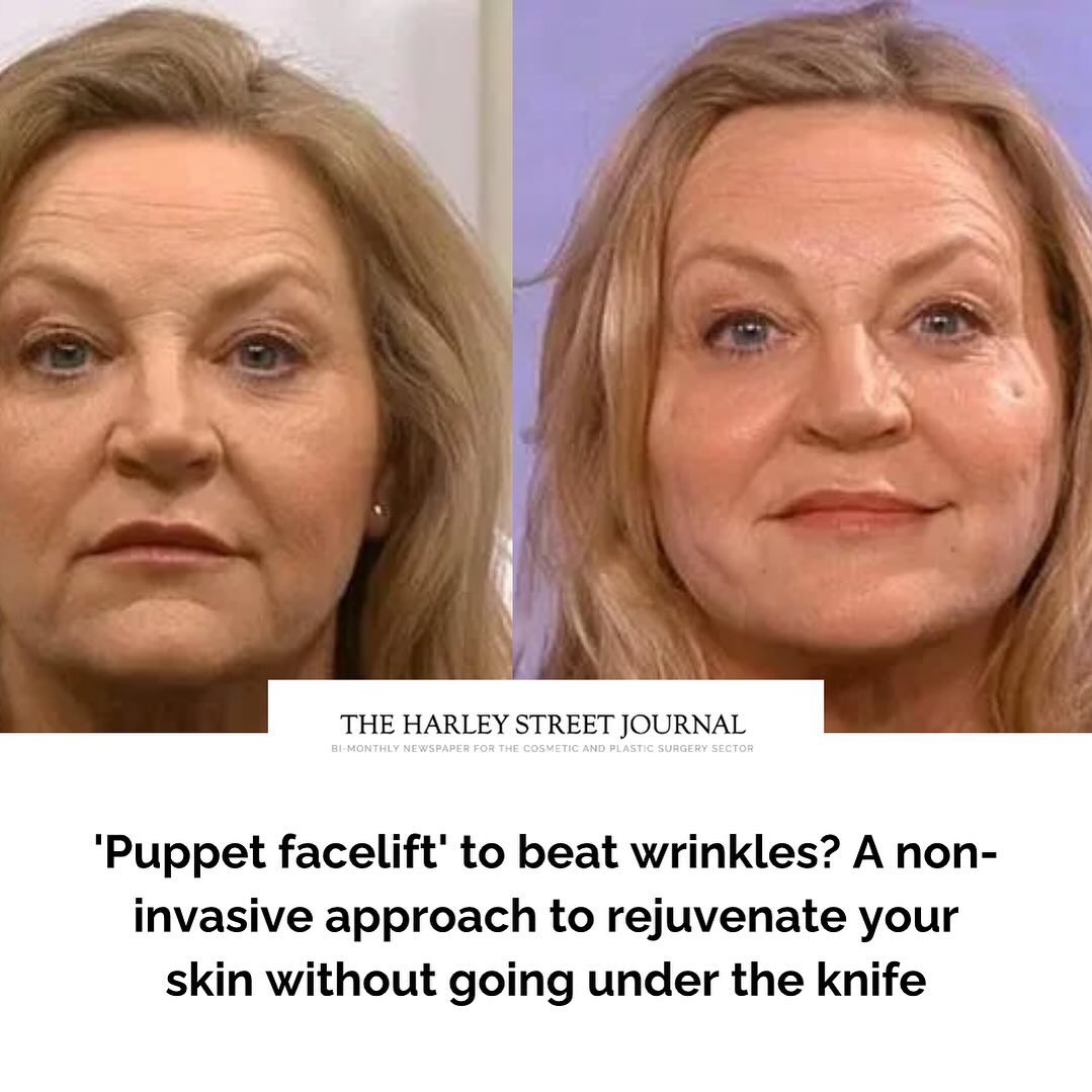 PICO Negative Pressure Wound Therapy to challenge surgical incision ...